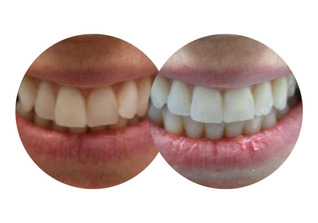 Invisalign – Salin Dentistry